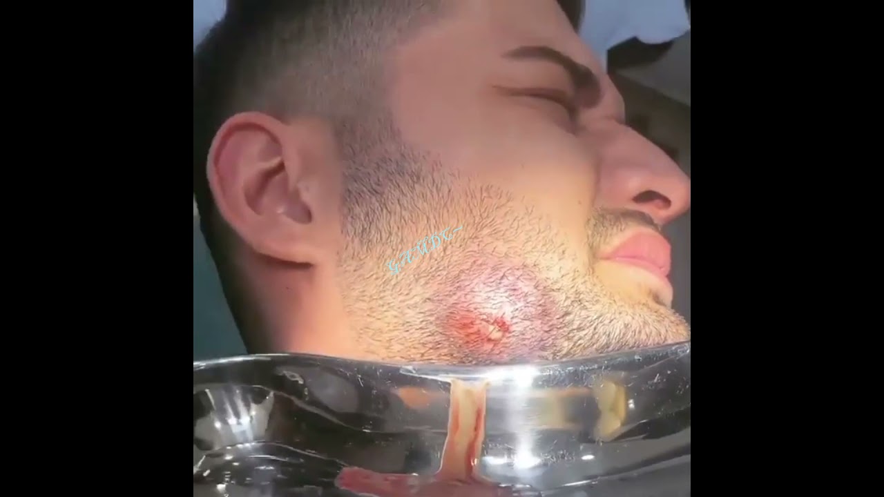 Extraoral Abscess Drainage - Drenagem de Abscesso em Face - YouTube