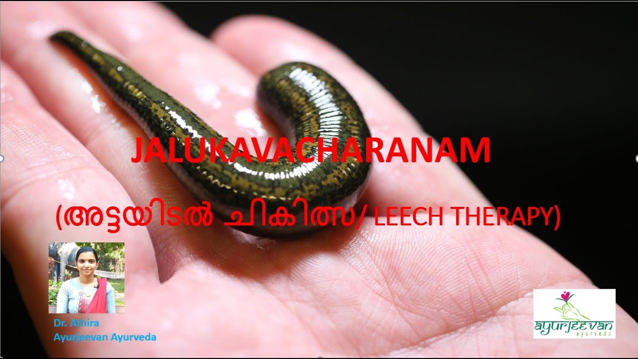JALAUKAVACHARANAM - അട്ടയിടൽ ചികിത്സ/ LEECH THERAPY - IMPORTANCE IN ...