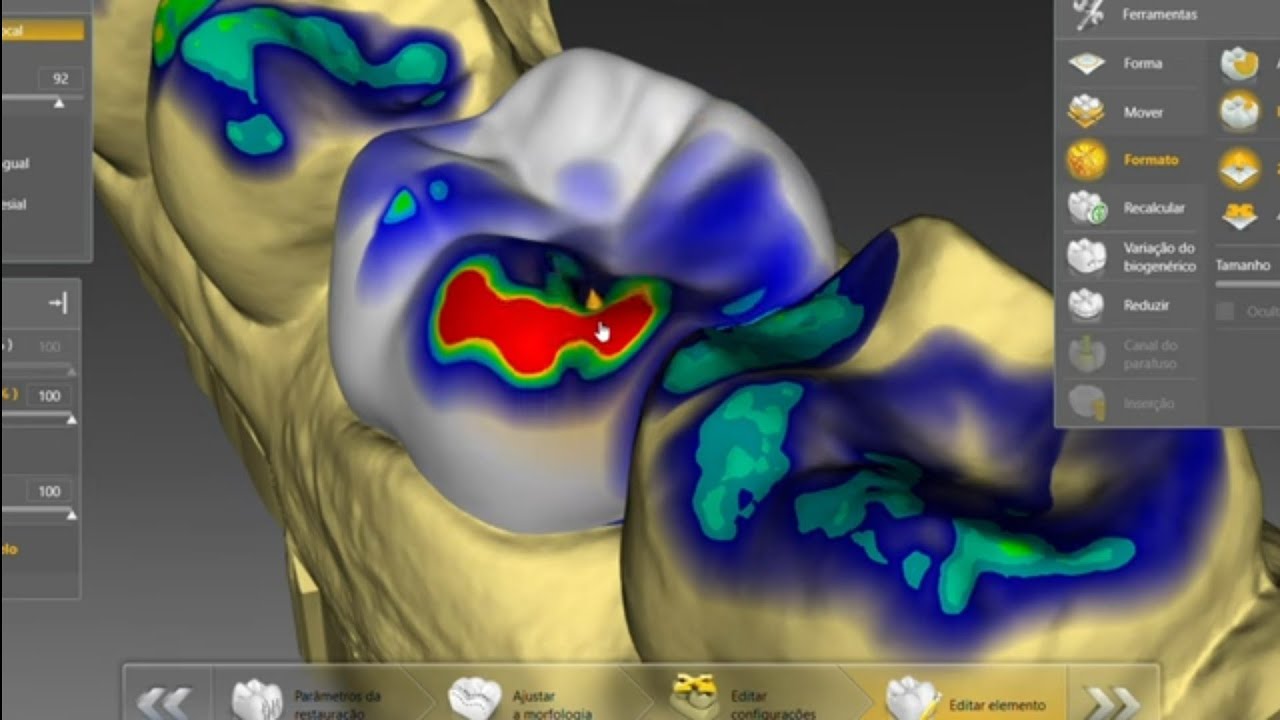 Mastering Ceramic Restorations: Step-by-Step with inLab Software - YouTube
