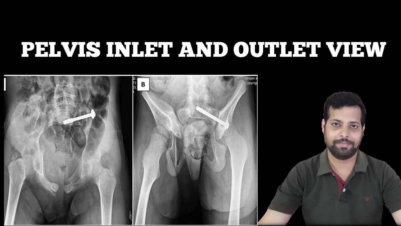 FROG VIEW, INLET AND OUTLET VIEW PELVIS - YouTube