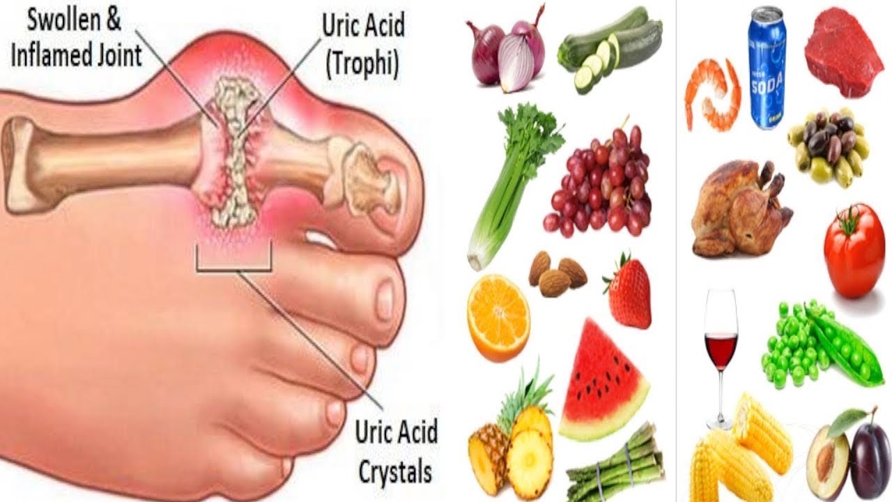 How To Quickly Remove Uric Acid Crystallization From Your Body To Prevent Gout And Joint Pain How To Quickly Remove Uric Acid Crystallization From Your Body To Prevent Gout And Joint Pain