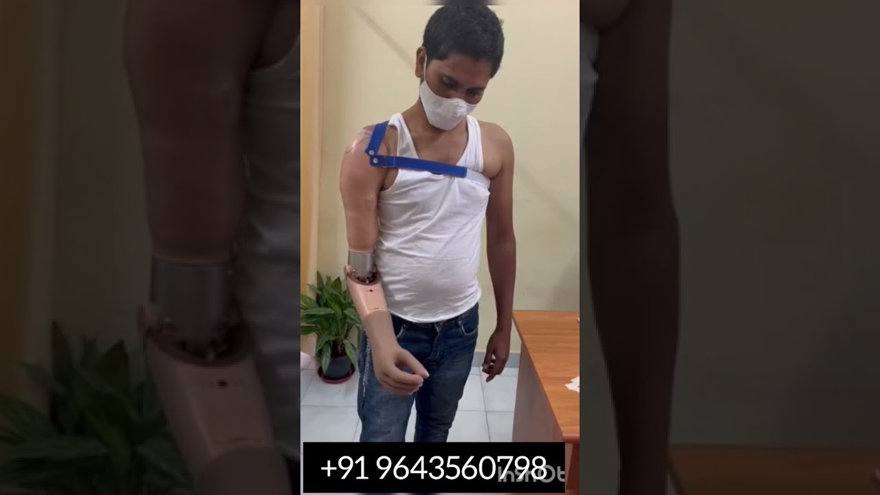 Artificial Hand l Hi-Tech Hand l Myoelectric Hand - YouTube