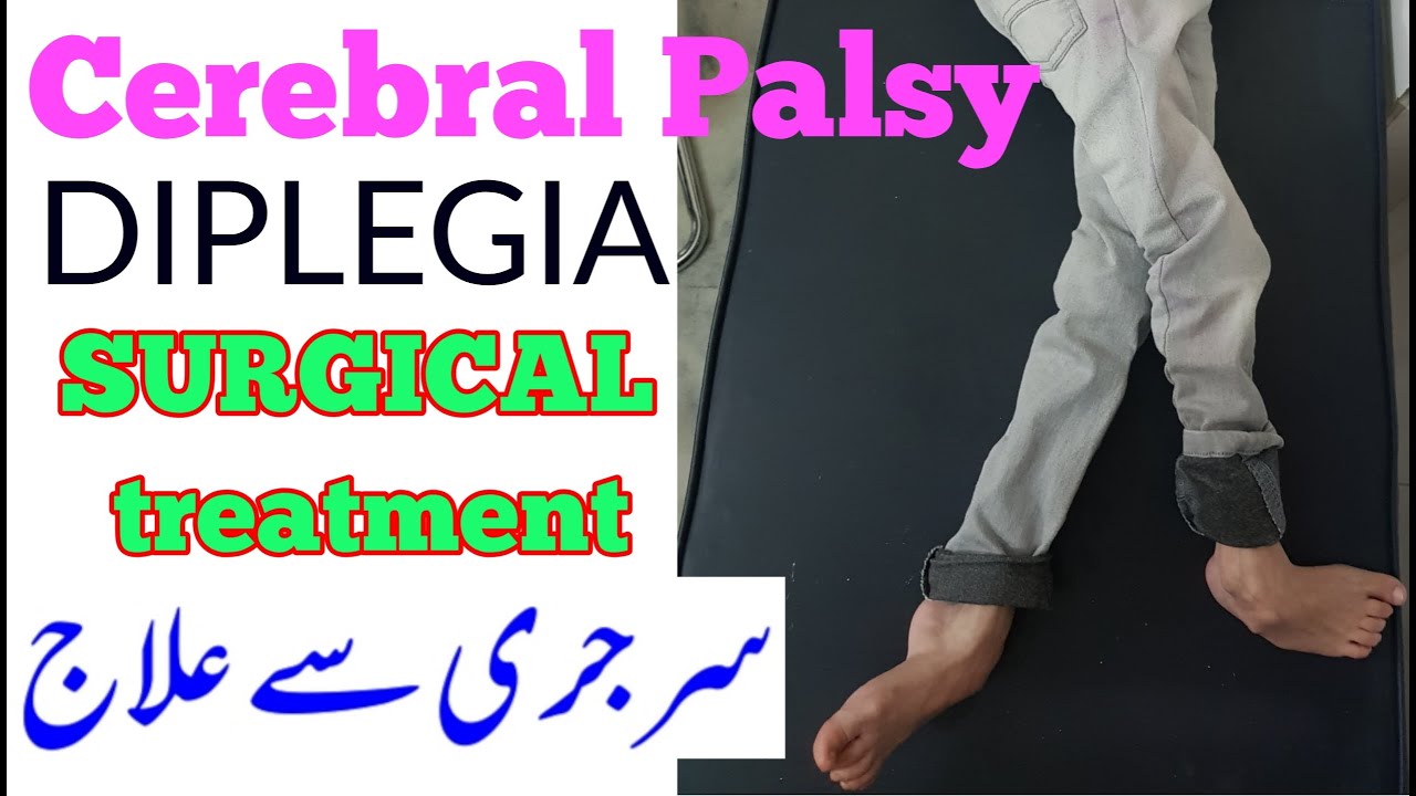 Video 5/ Cerebral Palsy Diplegia || Surgical treatment and ...