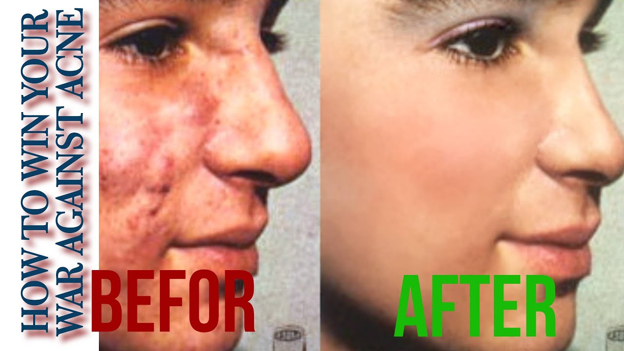 how to win your war against acne (2) acne scars cause prevention and ...