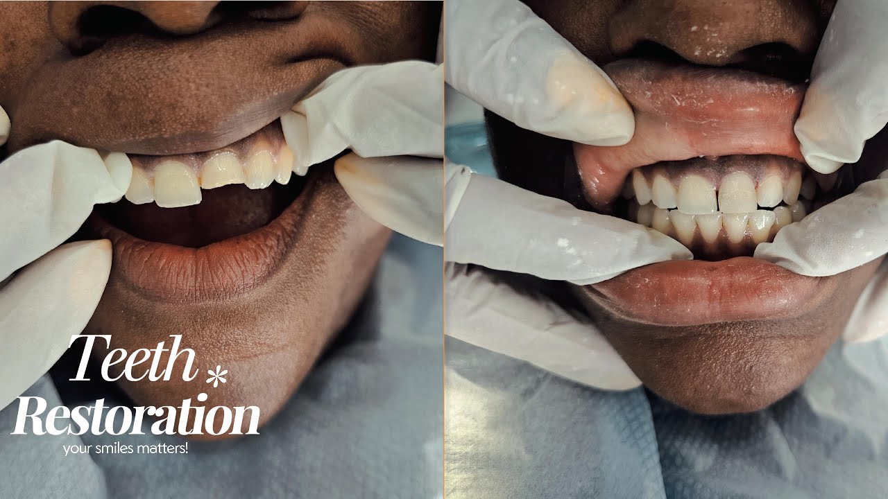 Transform Your Smile in Minutes! Stunning Tooth Build-Up Before & After ...