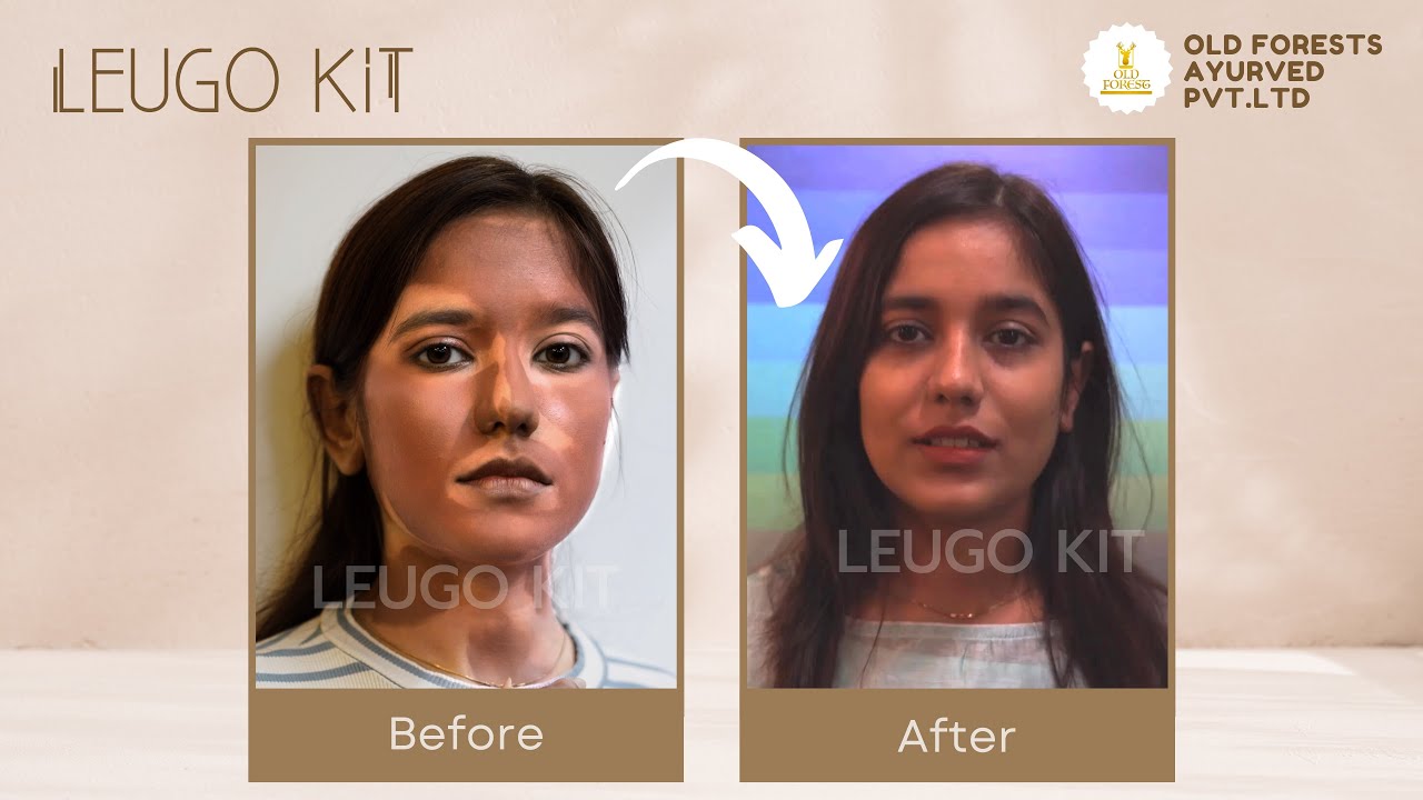 Safed daag ka ilaaj sabut ke saath |leugokit| leucoderma Ayurvedic ...