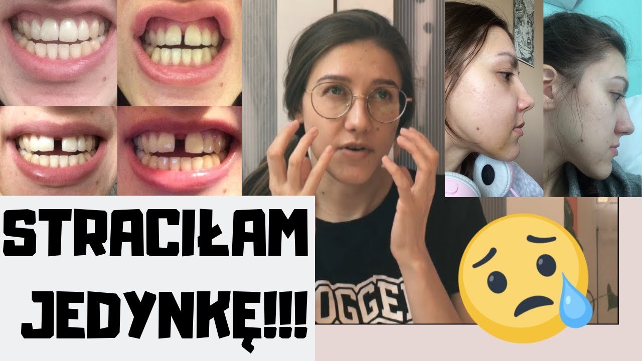 Poszerzenie szczęki / SARPE / SARME / TPD - Moja dystrakcja szczęki #8 ...