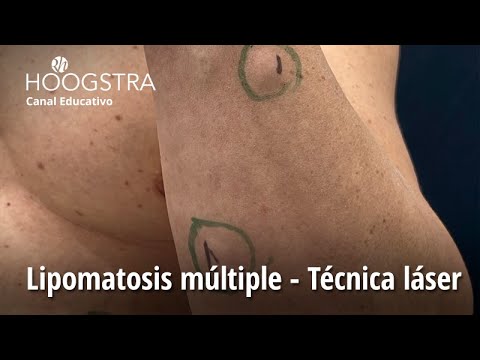 Lipomatosis múltiple - Técnica láser - 24157 - YouTube