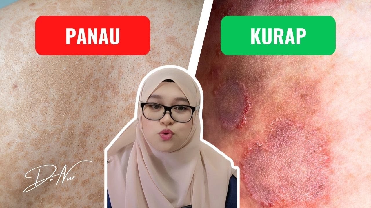 PANAU vs KURAP ? Sama kah? - [TANYA DR NUR] - YouTube