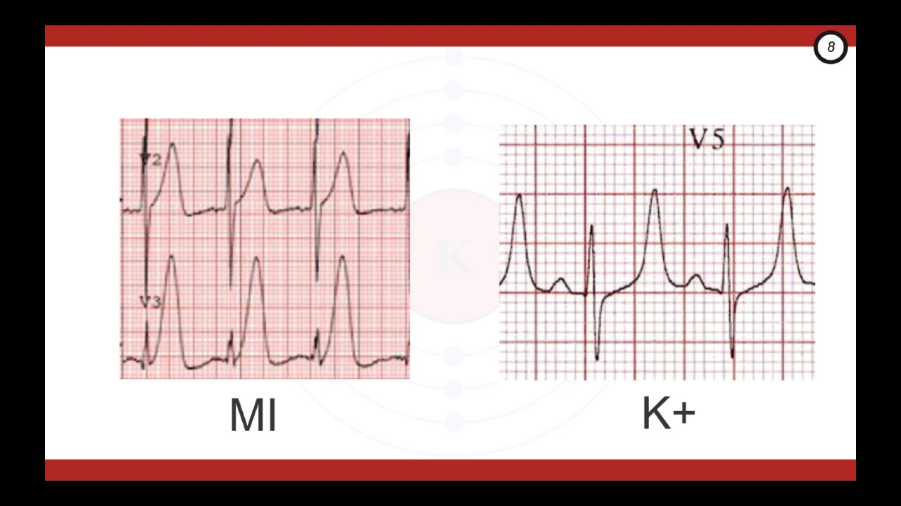 Emergency Management of Hyperkalemia (Part 1) - YouTube