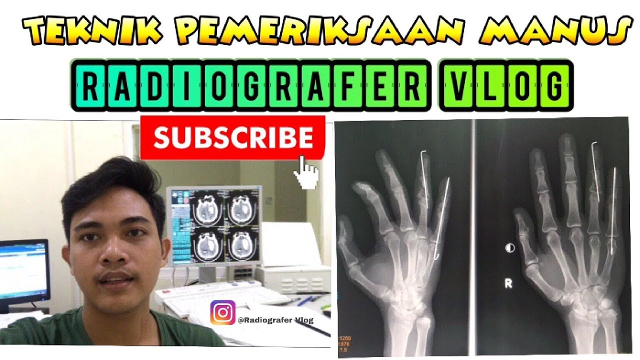 Teknik dan prosedur pemeriksaan rontgen manus ( Tangan ) //Radiografer ...