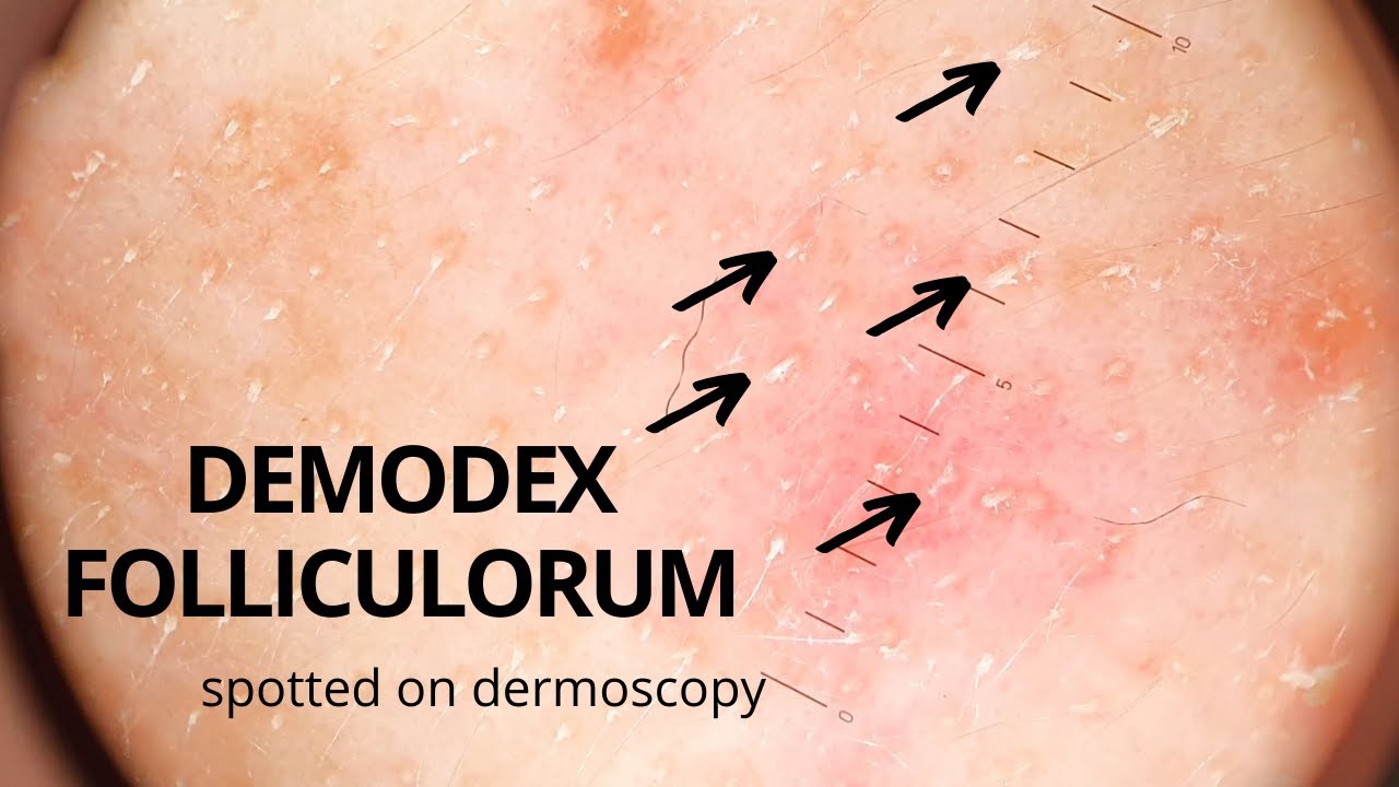 DEMODEX FOLLICULORUM vazuti la DERMATOSCOPIE - YouTube
