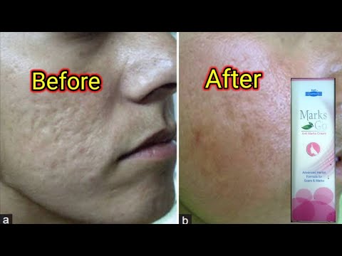 Best sunscreen for face || Mark go cream for marks on face after ...
