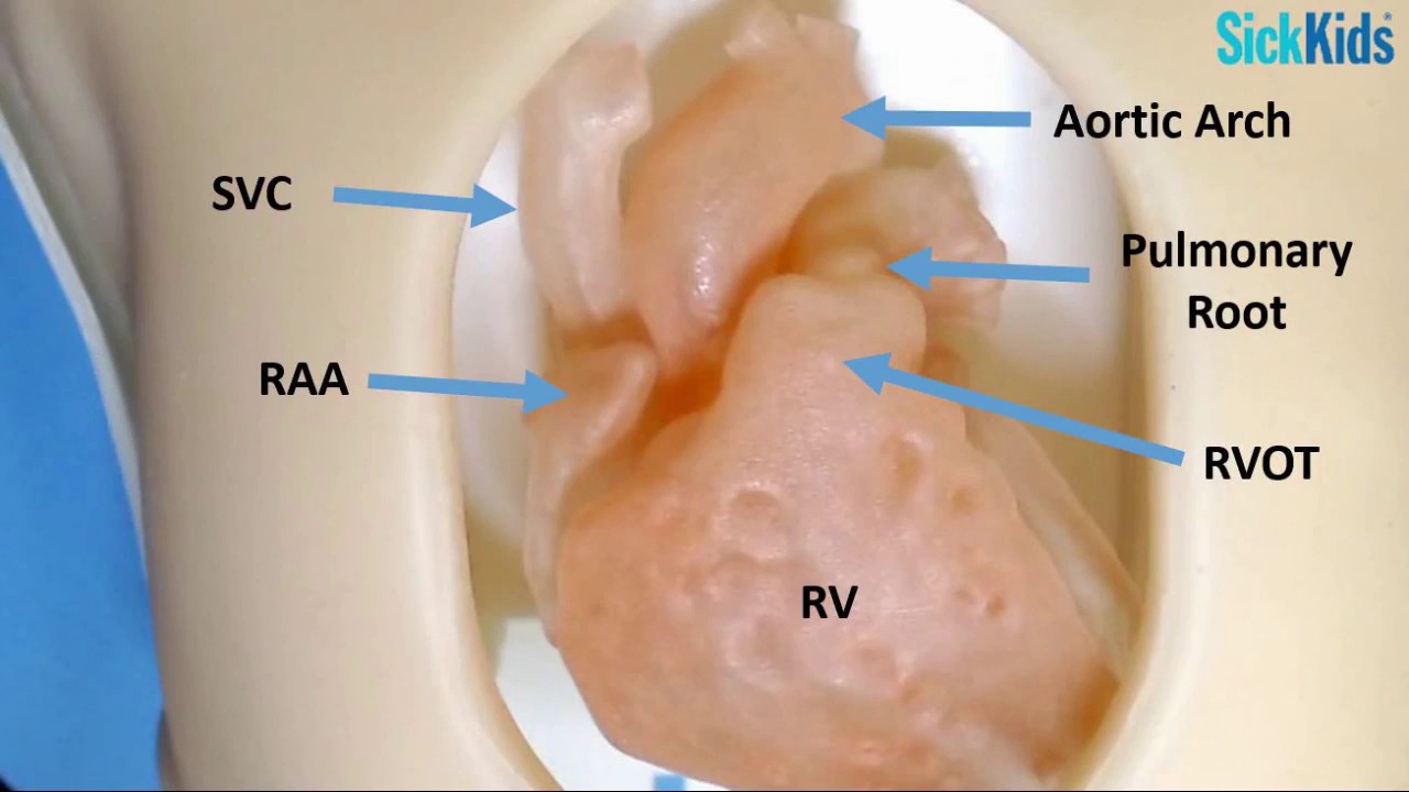 HOST - TOF Repair (Transannular patch) on a 3D-printed model - Dr ...