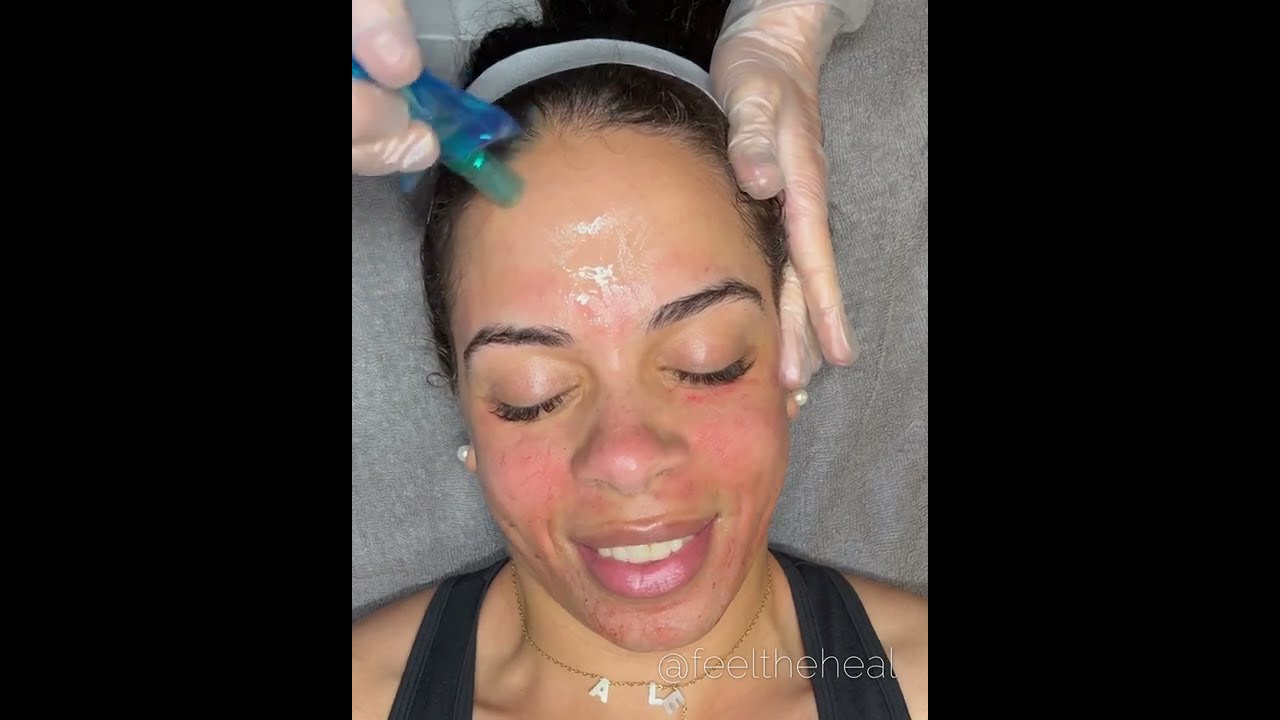 Dermaplaning & Microneedling face full video - YouTube