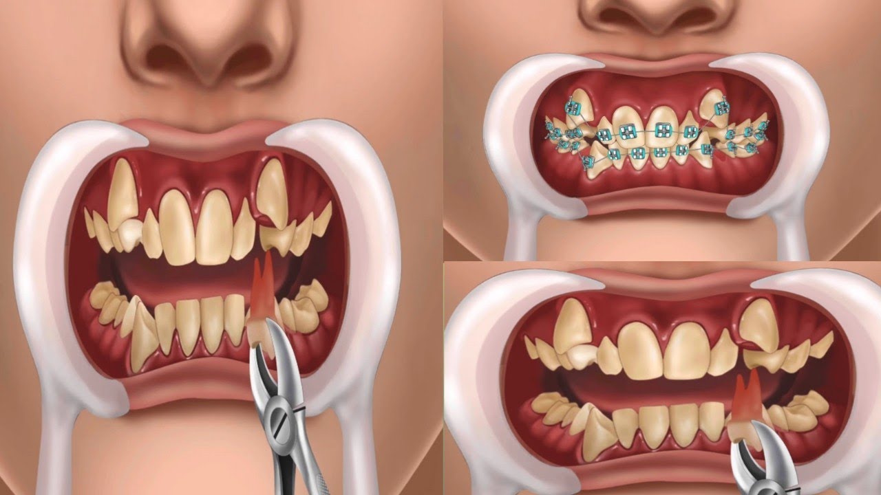 ASMR | Teeth scaling | Teeth cavity treatment animation - YouTube