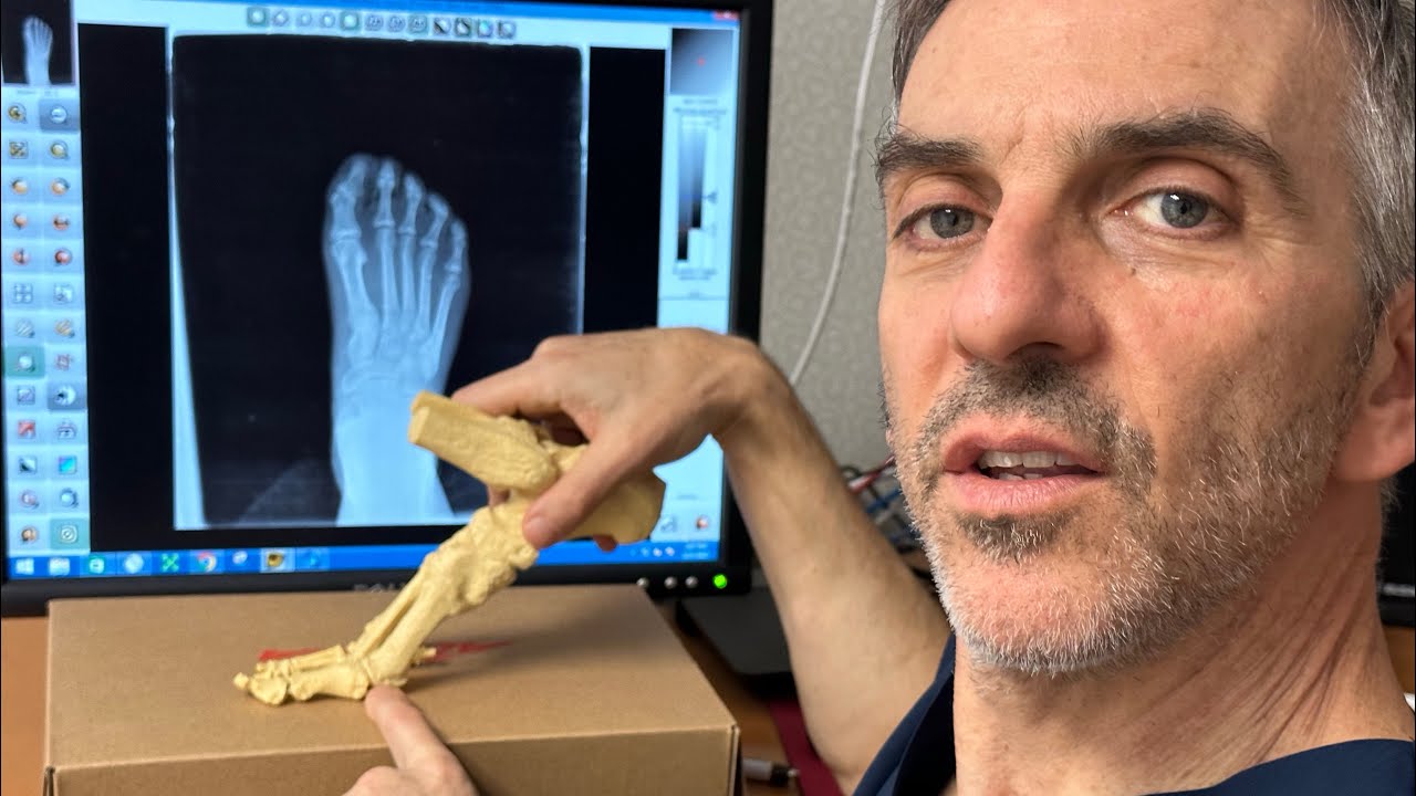 Fit Foot U W Dr Pearl Sesamoid Stress Reaction In Foot YouTube