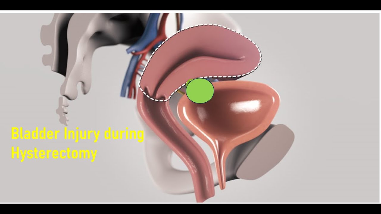 Managing a bladder injury during hysterectomy- Laparoscopically ...