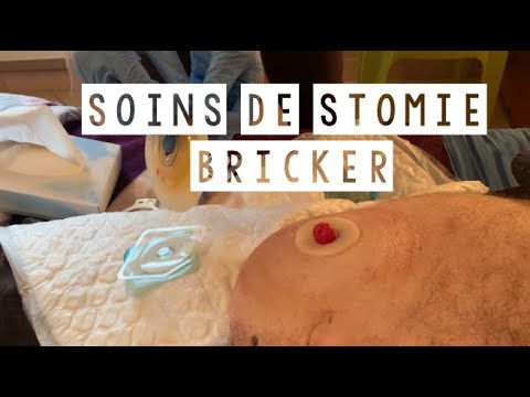 Le Bricker : Soins de stomie urinaire - YouTube