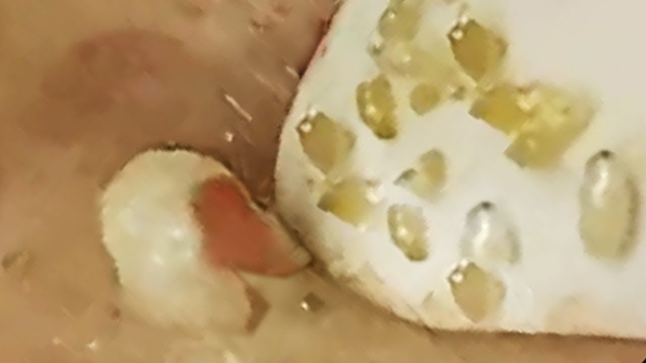 Blackheads Extraction Whiteheads Removal Pimple Popping #172 - YouTube