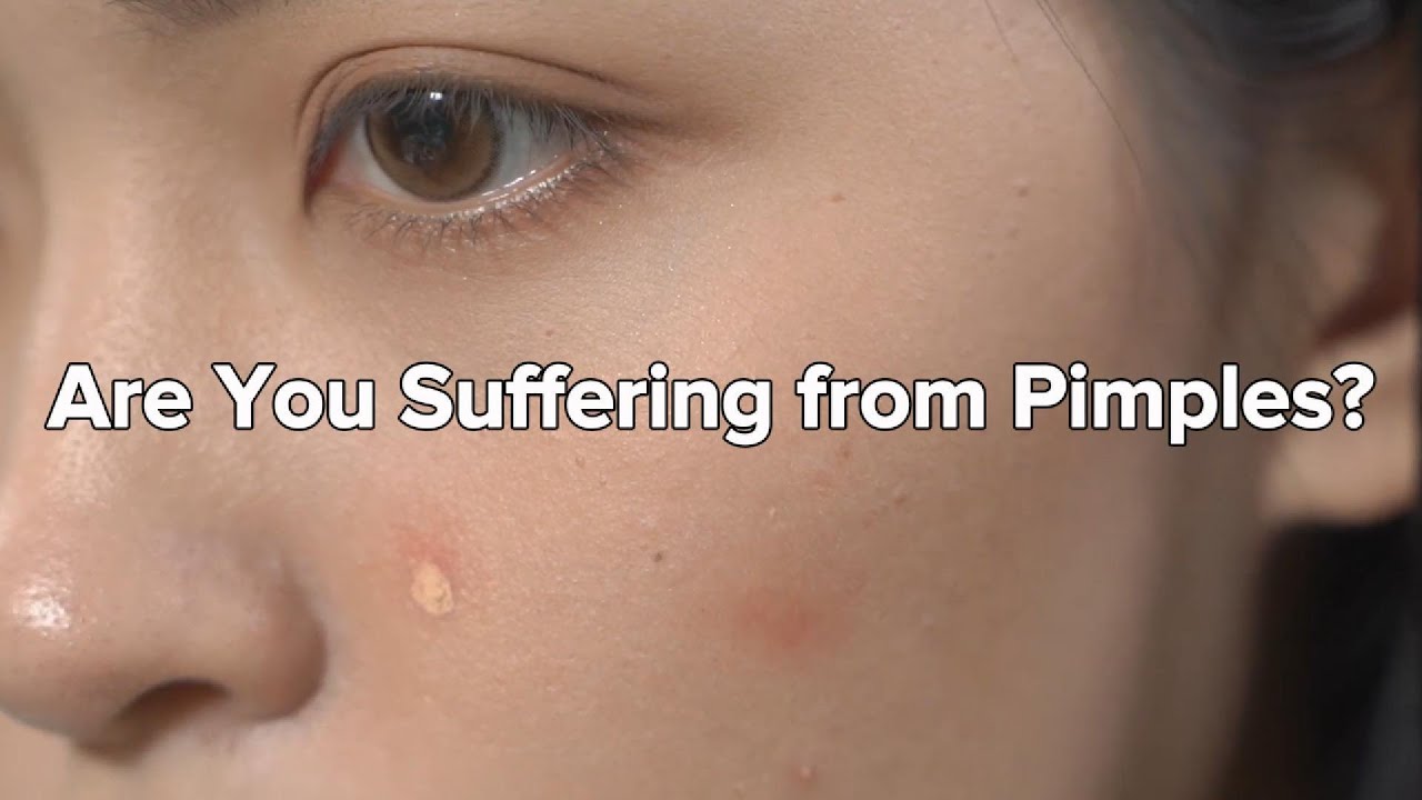 Are you suffering pimples? - YouTube