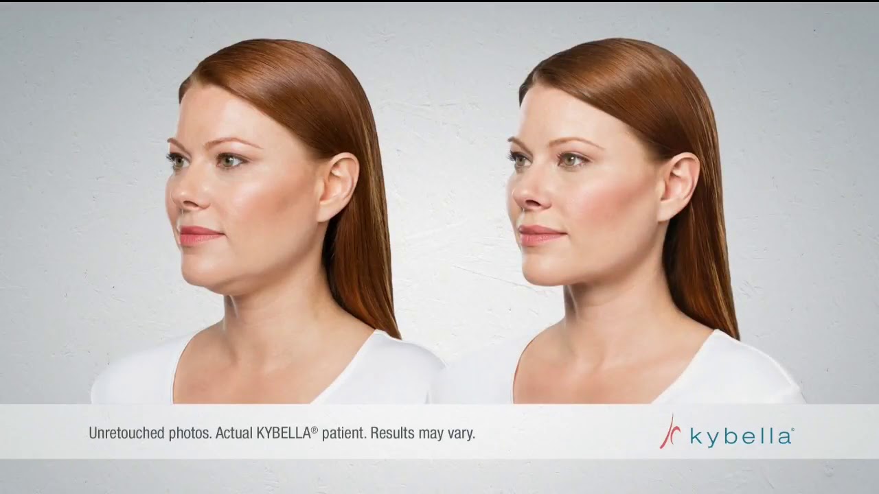 Kybella Commercial - YouTube