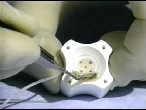 Barron Corneal Transplant--Katena - YouTube