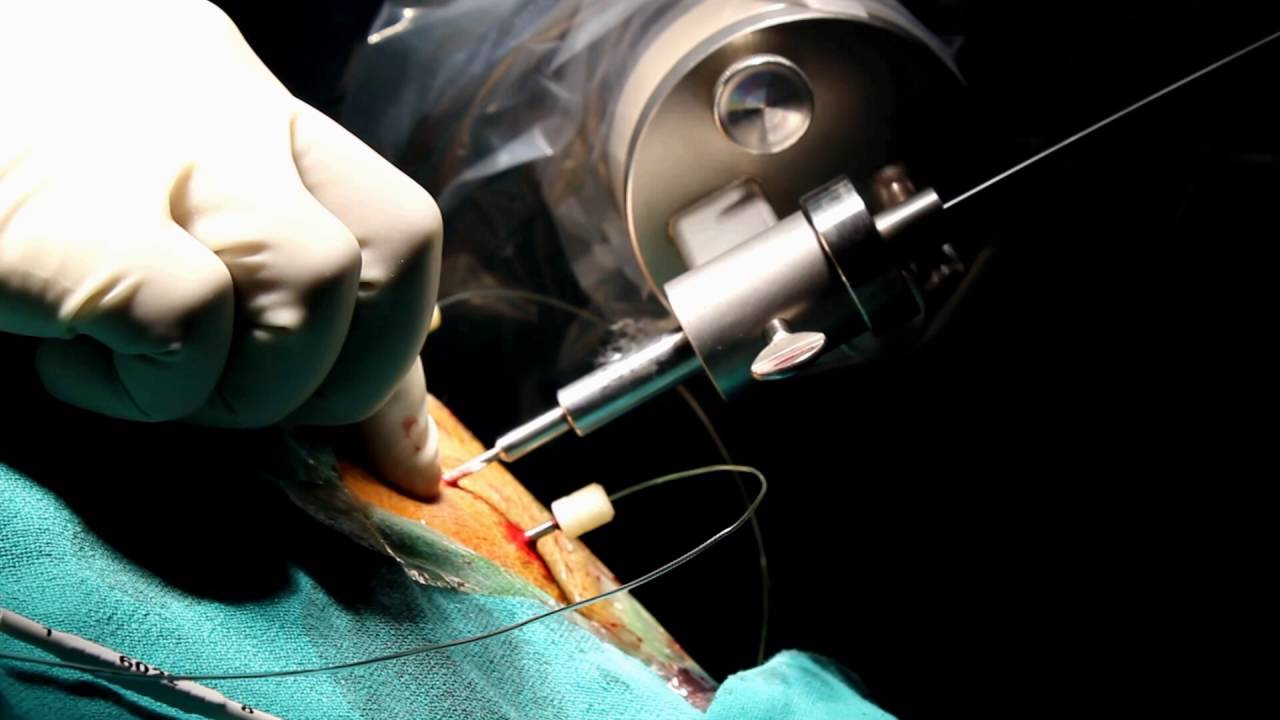Prof PSC stereo EEG Implantation - YouTube