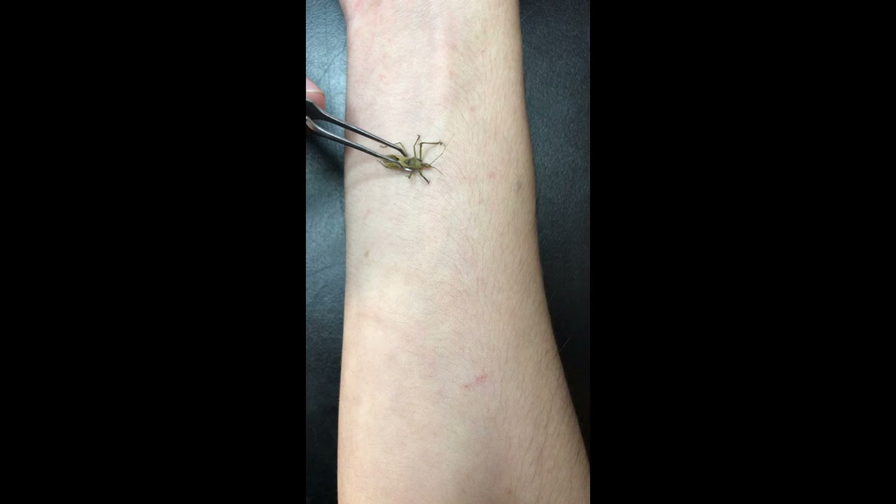 Leafhopper Assassin Bug Bite YouTube Leafhopper Assassin Bug Bite YouTube