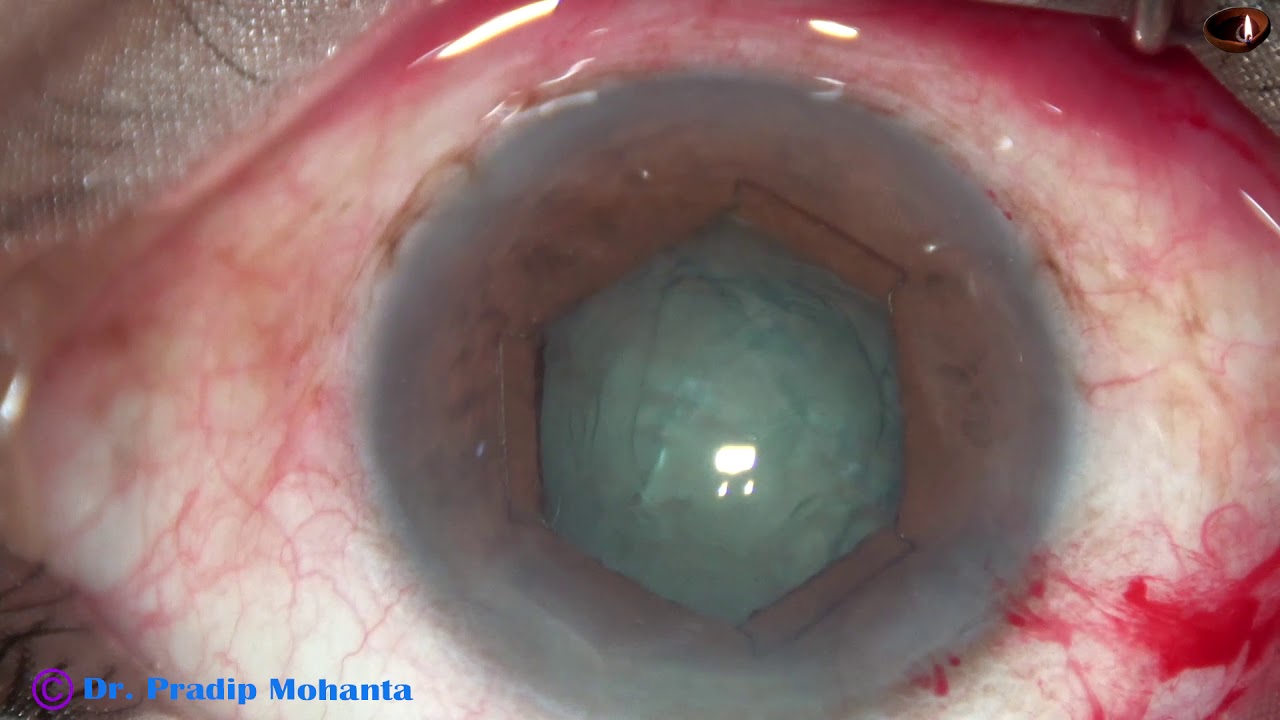 Subtenon block and Small-pupil-Phaco for a one-eyed patient : PM, 16/7 ...