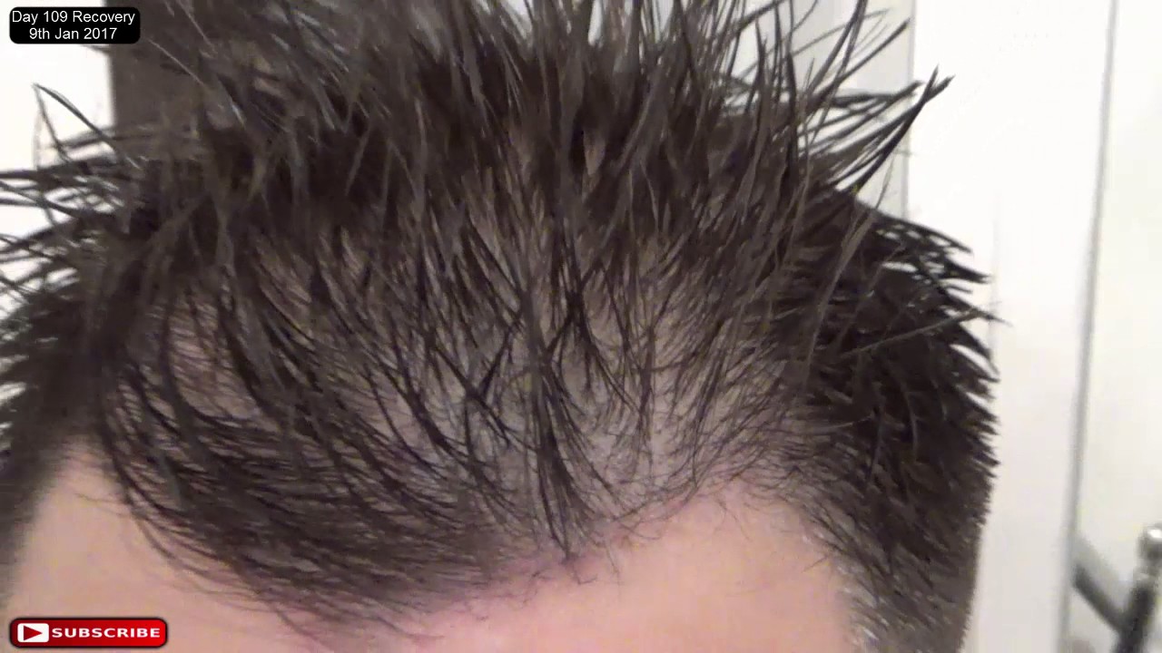 FUE Hair Transplant: Day 109 Post Op Recovery - YouTube