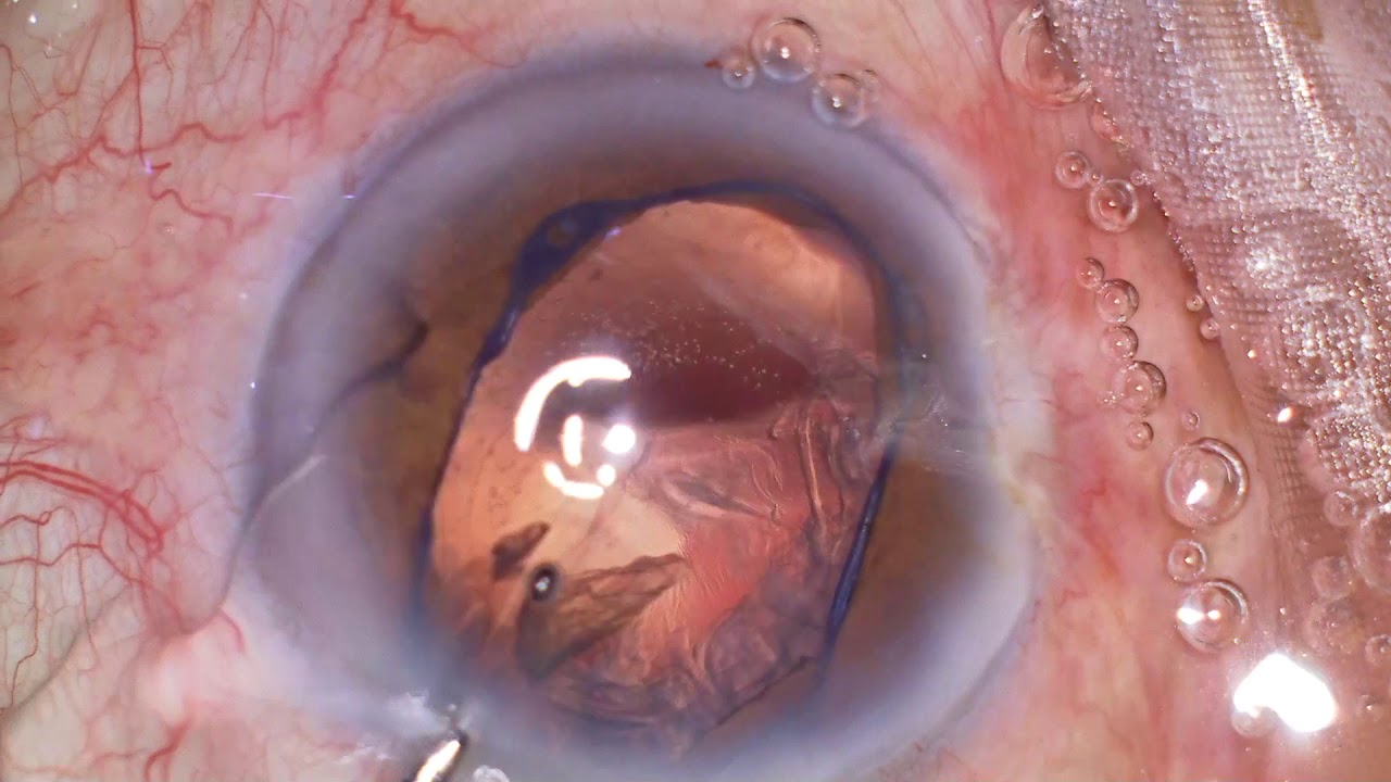 Small pupil cataract surgery with OASIS Ring - YouTube