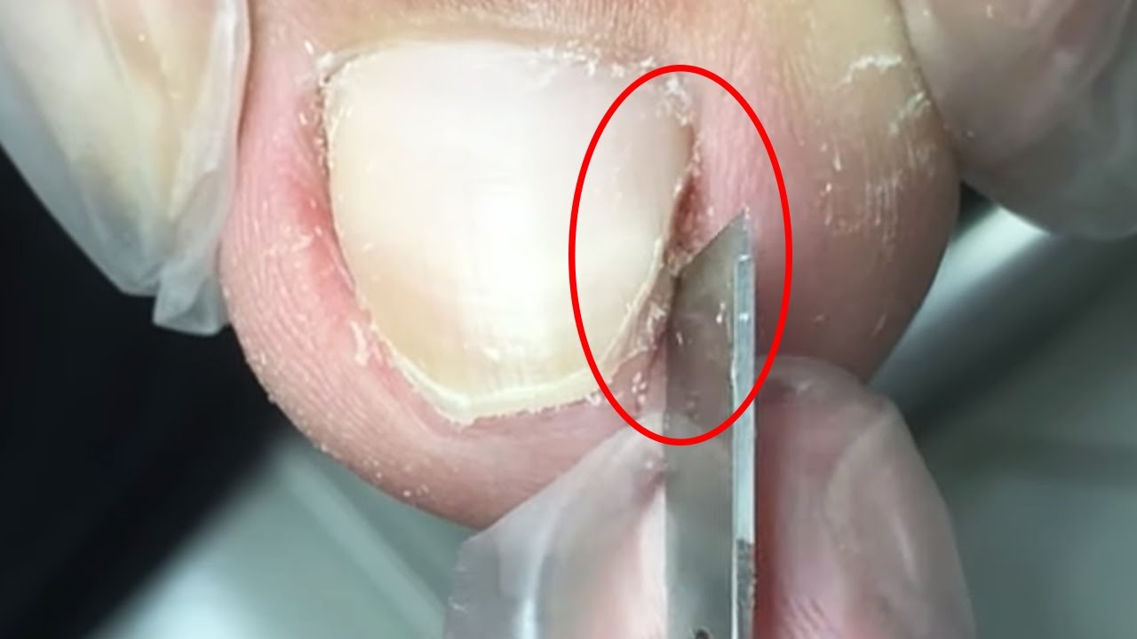 Curly toenails, carefully trimmed【Dr. Zhang】 - YouTube