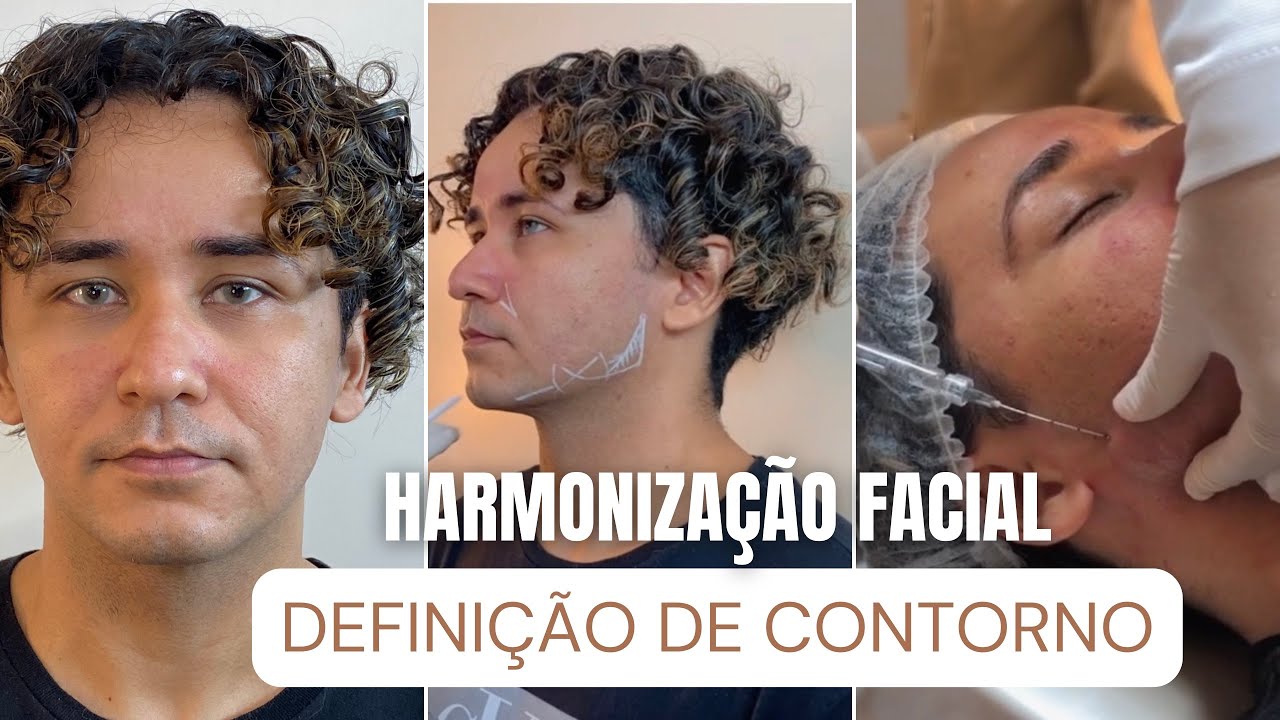 Harmonização Facial Surpreendente: Antes e Depois - Transformação com ...