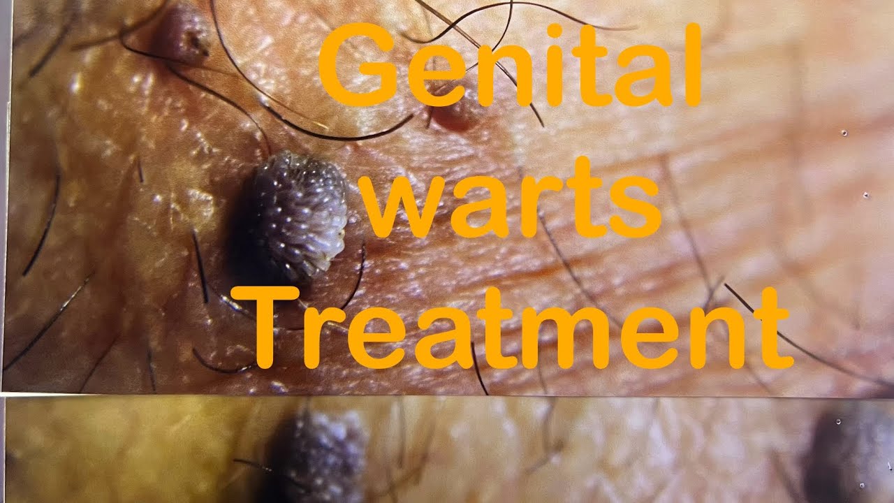 HPV Genital Warts Men Surgery and Treatment | Perfect & Excellent ...