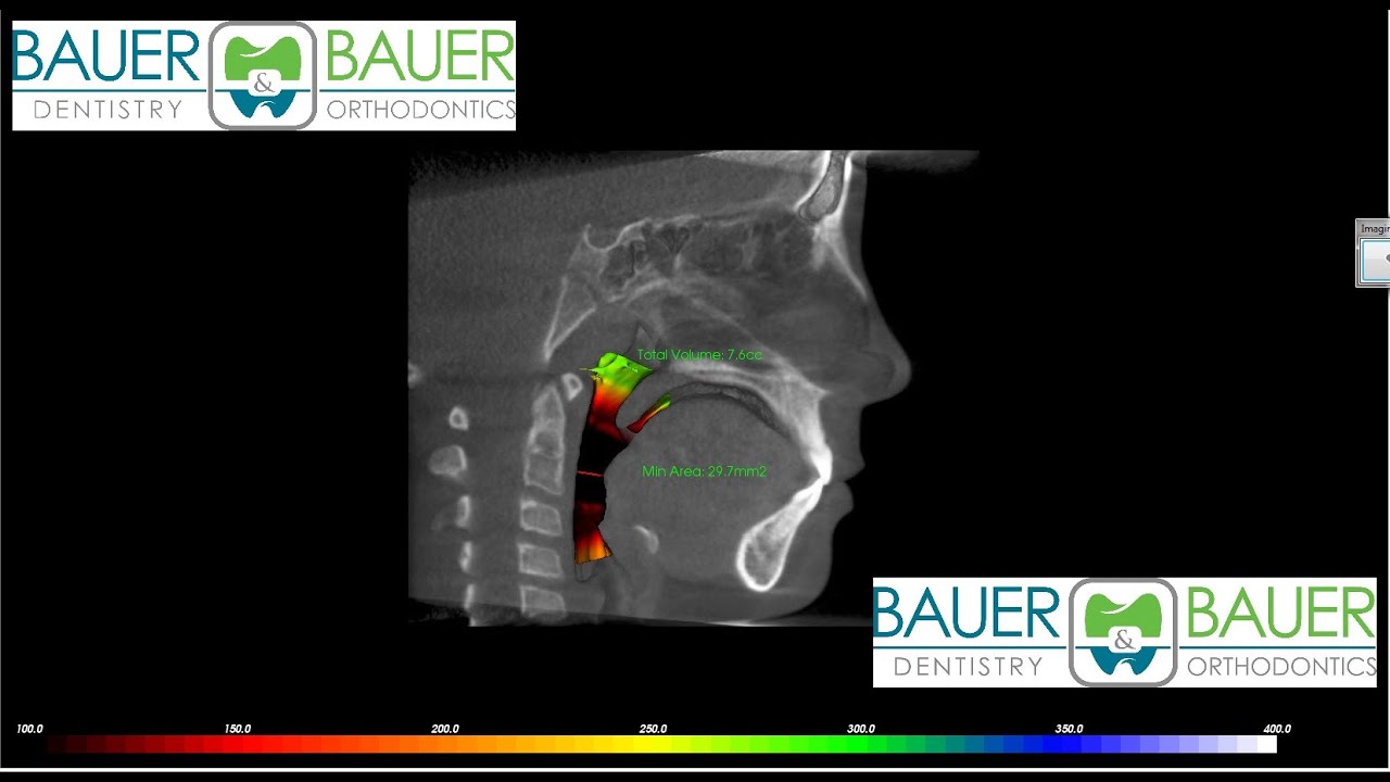 Airway analysis - 3D CBCT with iCAT - Wheaton Orthodontist - YouTube