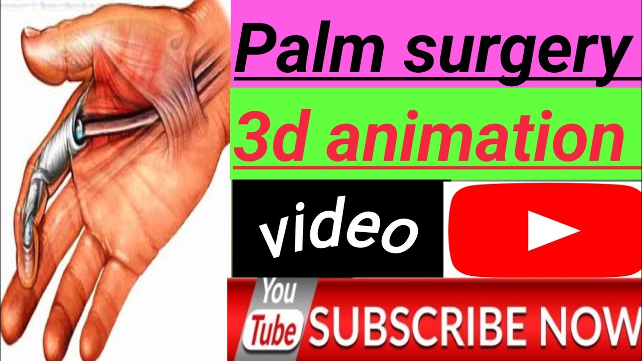 palm surgery to change your future.plam surgery 3d animation video ...