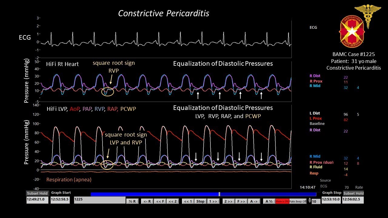 BAMC 1225 Constrictive Pericarditis and Pericardial Knock - YouTube