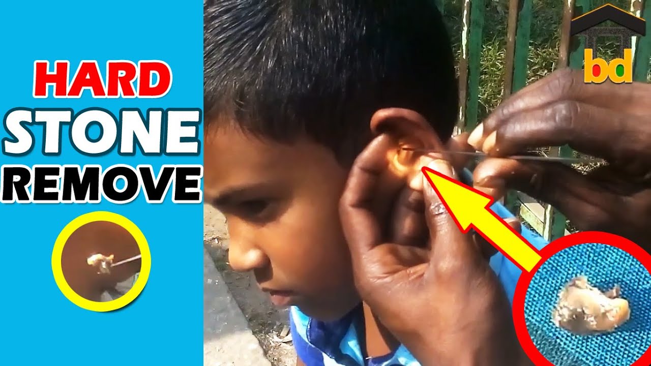 100% Safely Removed Massive Earwax From 7 Years Kid II Difficult Wax ...