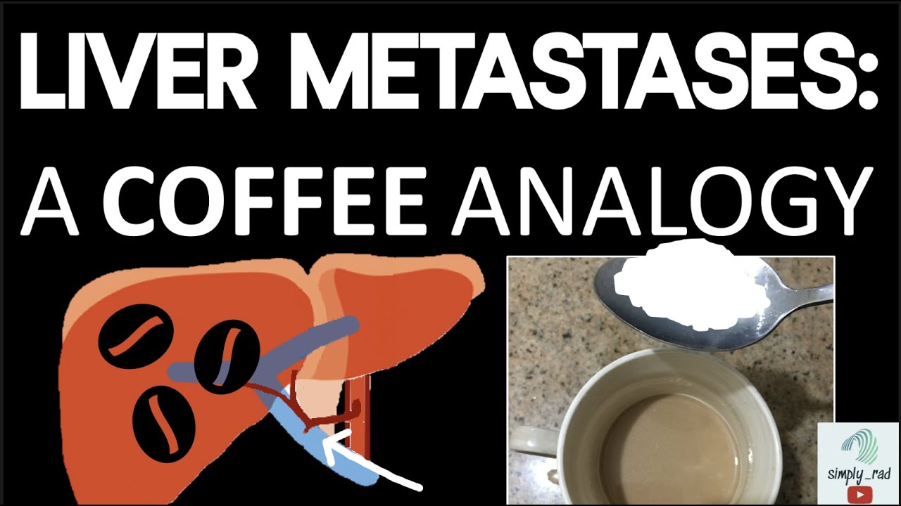 Liver Metastases: A Coffee Analogy (radiology, CT) - YouTube