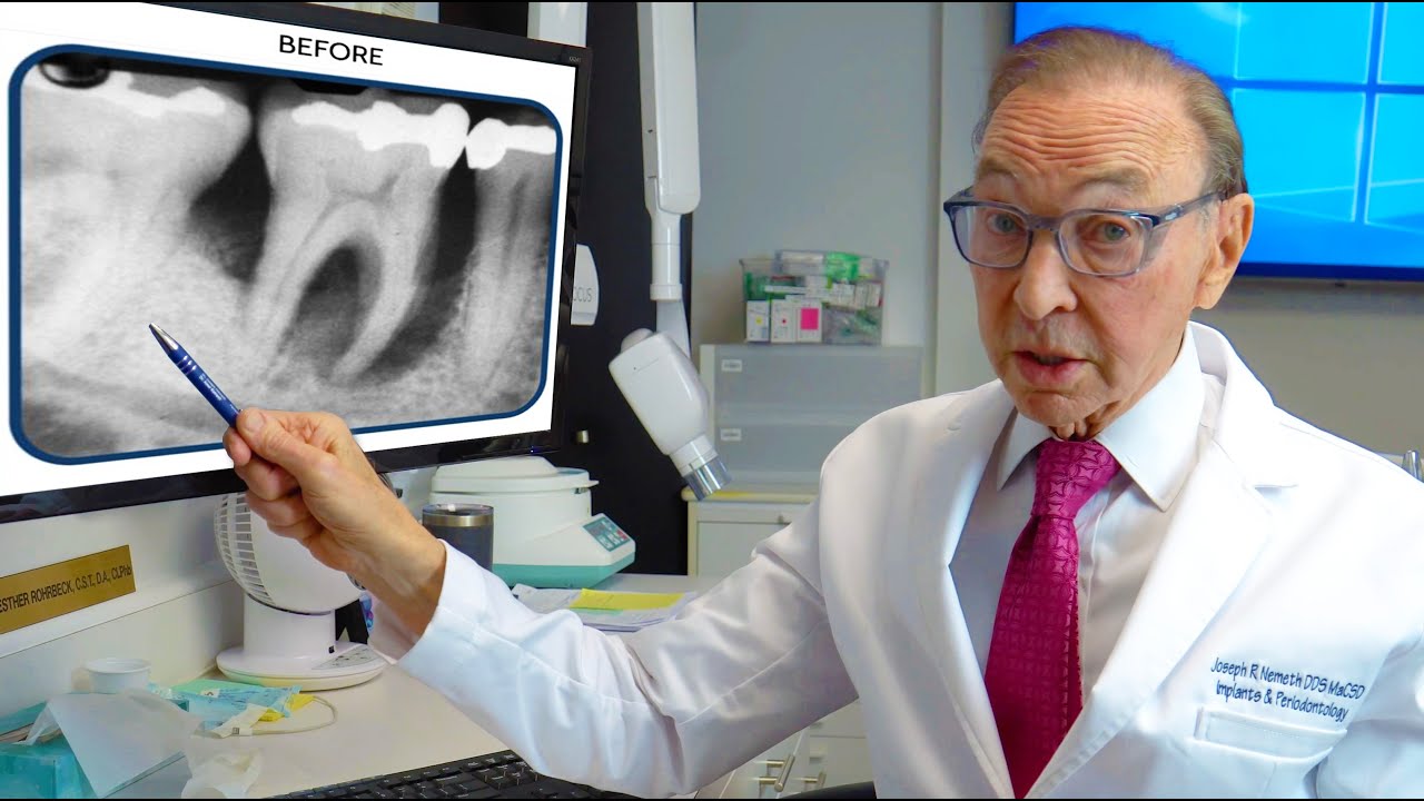 Bone Growth Can SAVE Teeth Damaged by Gum Disease! Before & After ...