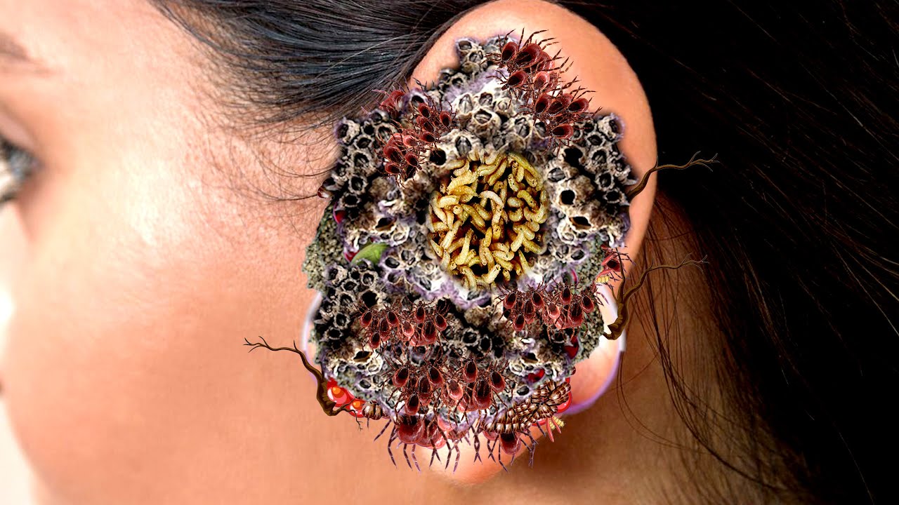 Surgeon Simulator 2 - ASMR Removes Large Pustules & Parasitic Maggots ...