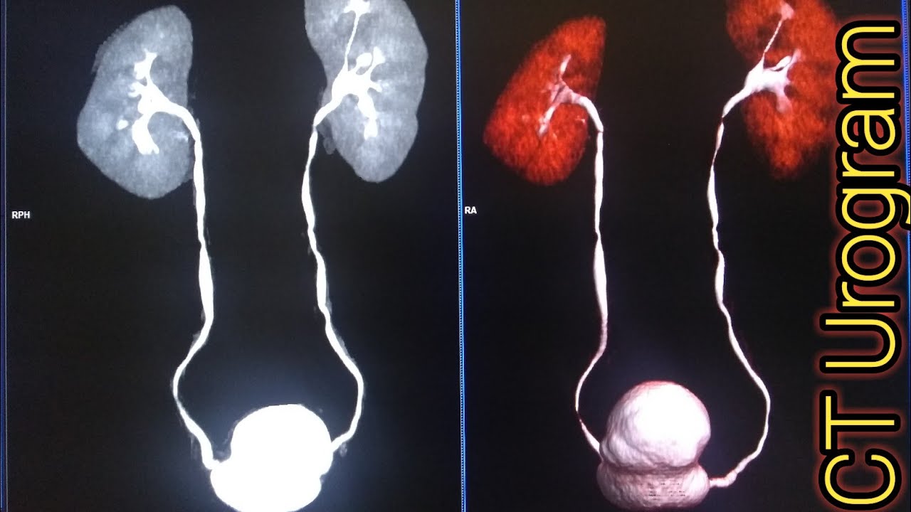 CT Urogram siemens somatom go now - YouTube