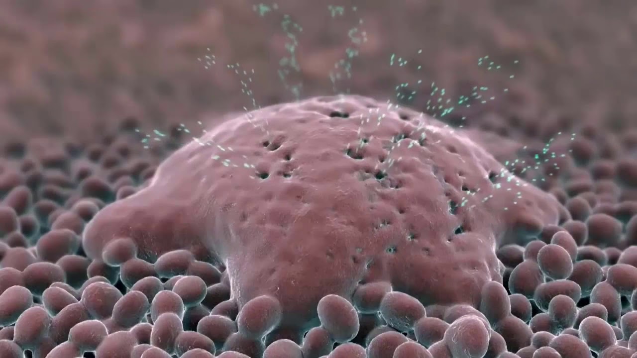 Was ist ein malignes Lymphom - YouTube