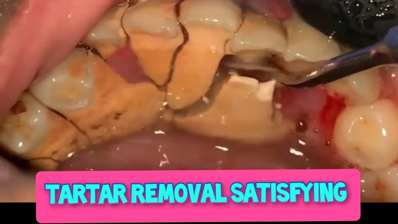 TAR TAR REMOVAL ON TEETH / CARA MEMBERSIHKAN KARANG GIGI / GIGI PEROKOK ...