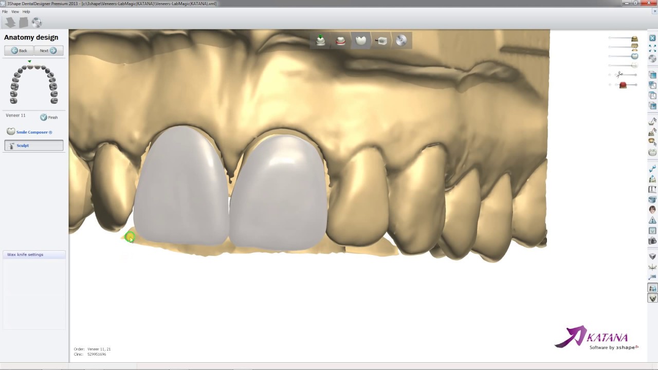 How to design Digital Veneers in 3Shape (2) - YouTube