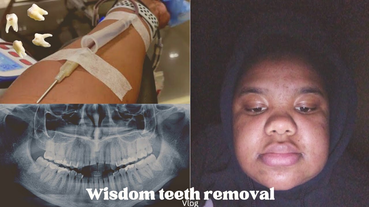 I got surgery!! |SOUTH AFRICAN YOUTUBER | FAST RECOVERY |(SURGERY ...