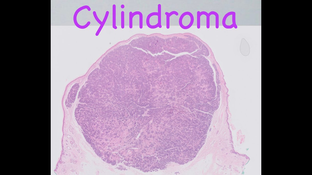 Cylindroma - YouTube