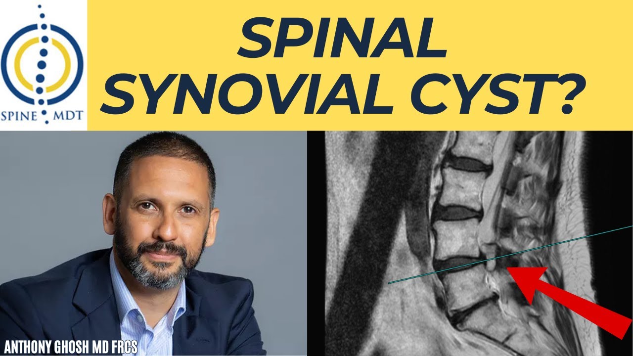 What Is a Synovial Cyst of the Spine? - Spine Surgeon Explains - YouTube