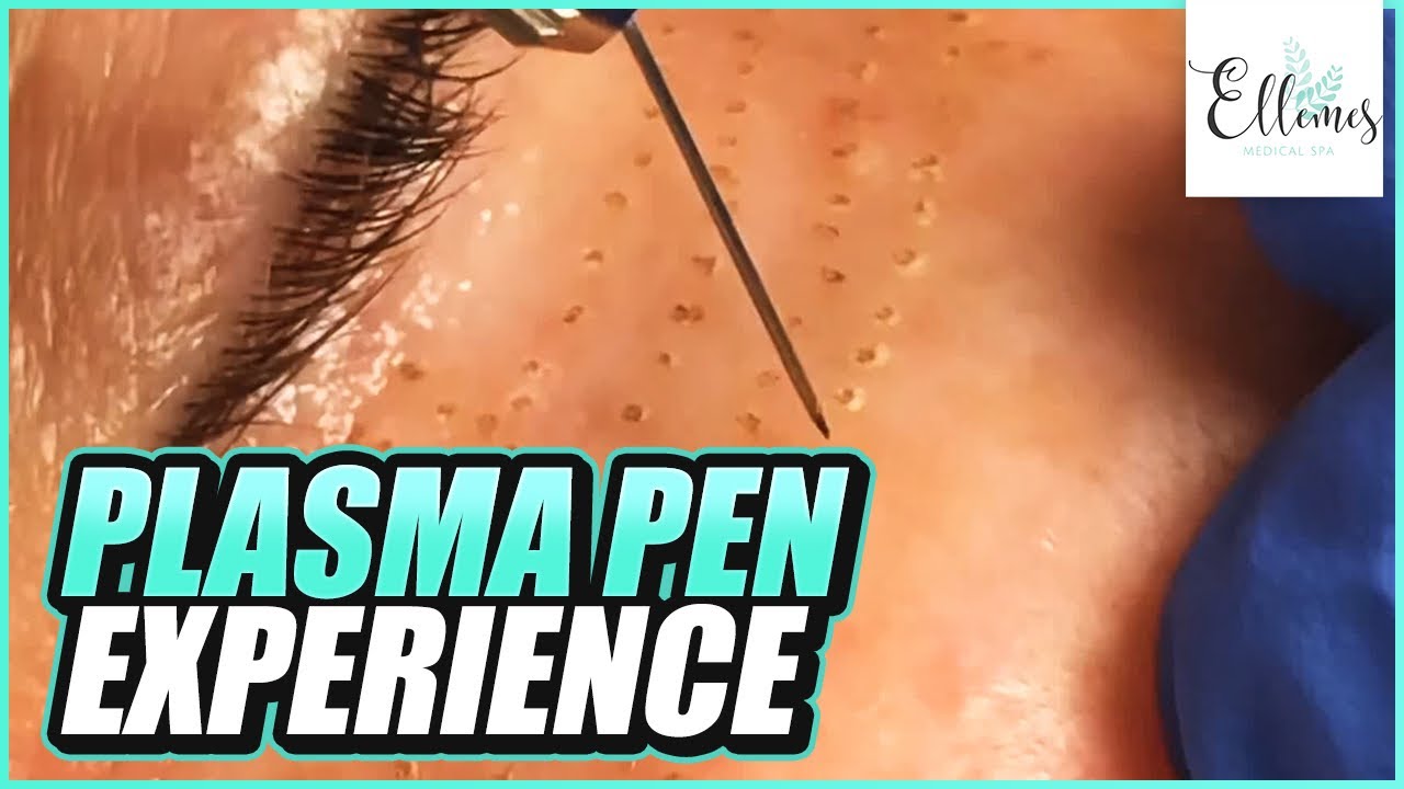 Plasma Pen Fibroblast Experience | Skin Tightening Atlanta Medical Spa ...